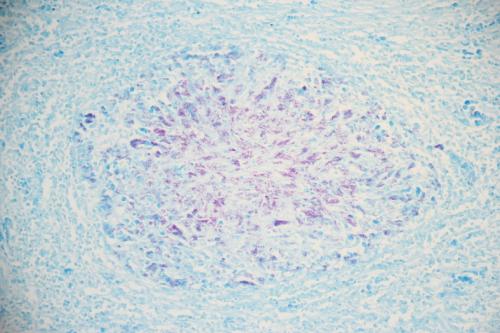 Acid Fast Bacteria (AFB) Human Lung Infection - Newcomer Supply