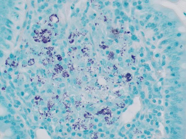 Acid Fast Bacteria (AFB), Kinyoun Staining Procedure - Newcomer Supply