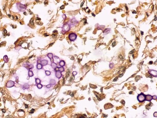 CRYPTOCOCCUS sp. Control Histology Slides