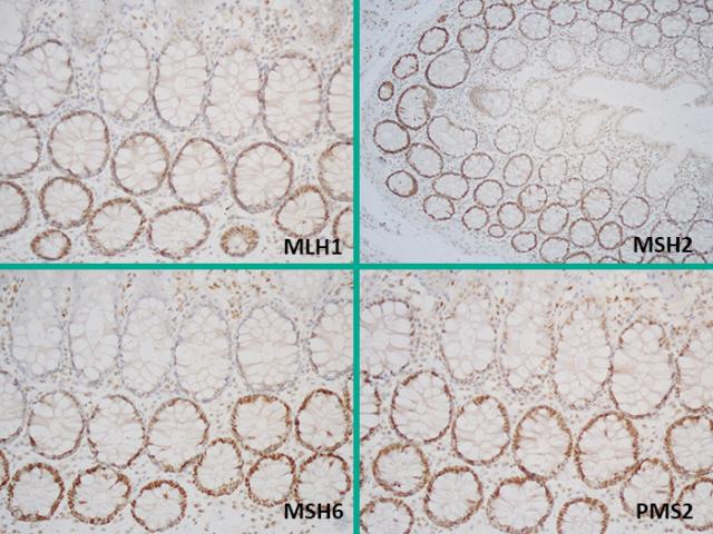 Mismatch Repair (MMR) Immnunohistochemistry Control Histology Slides